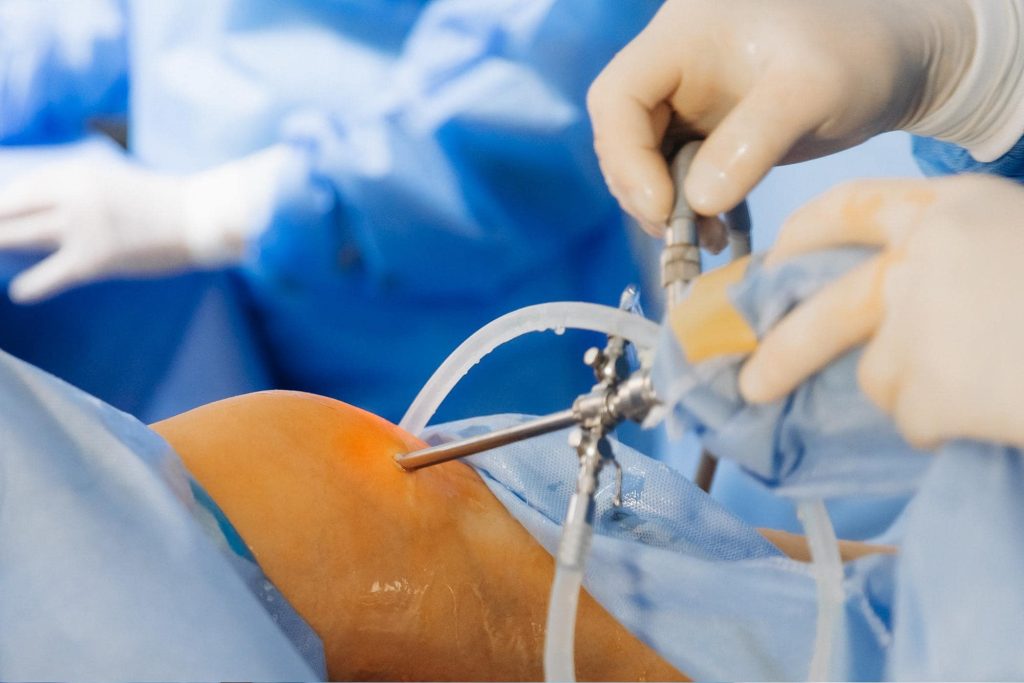 Total Knee Replacement Surgery: What Patients Need to Know - Inicio ...